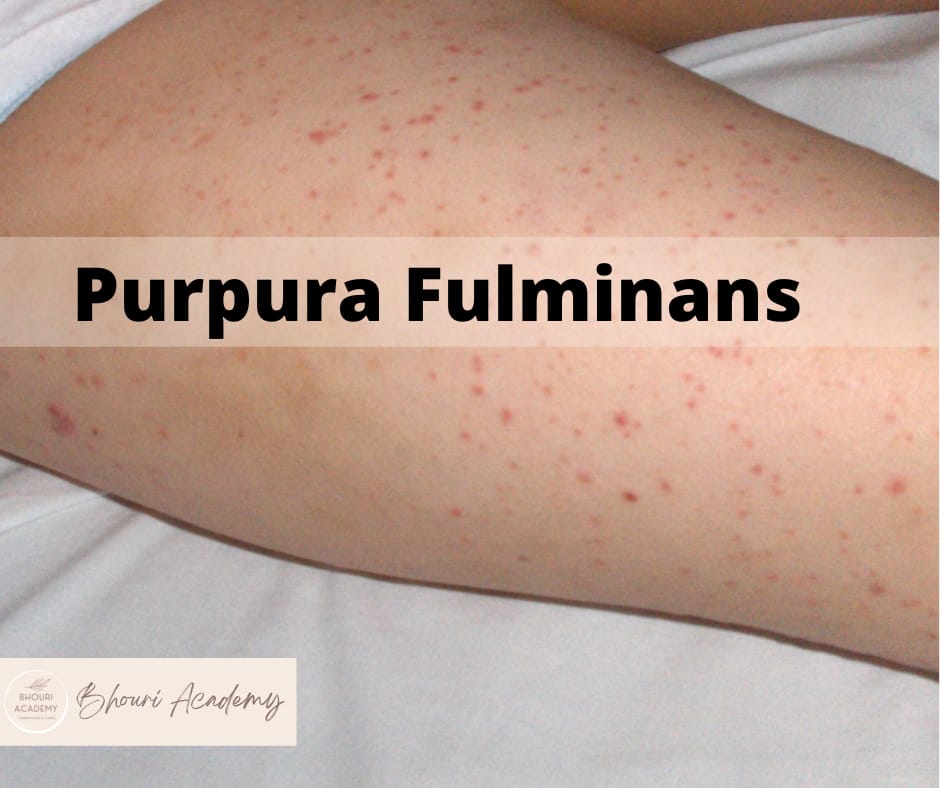Purpura Fulminans